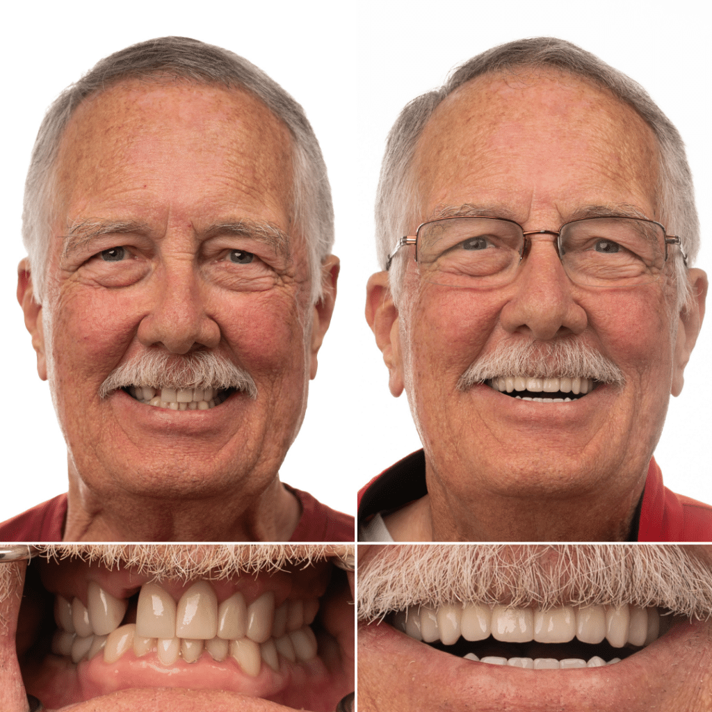 Transformations - ATL Dental Implants